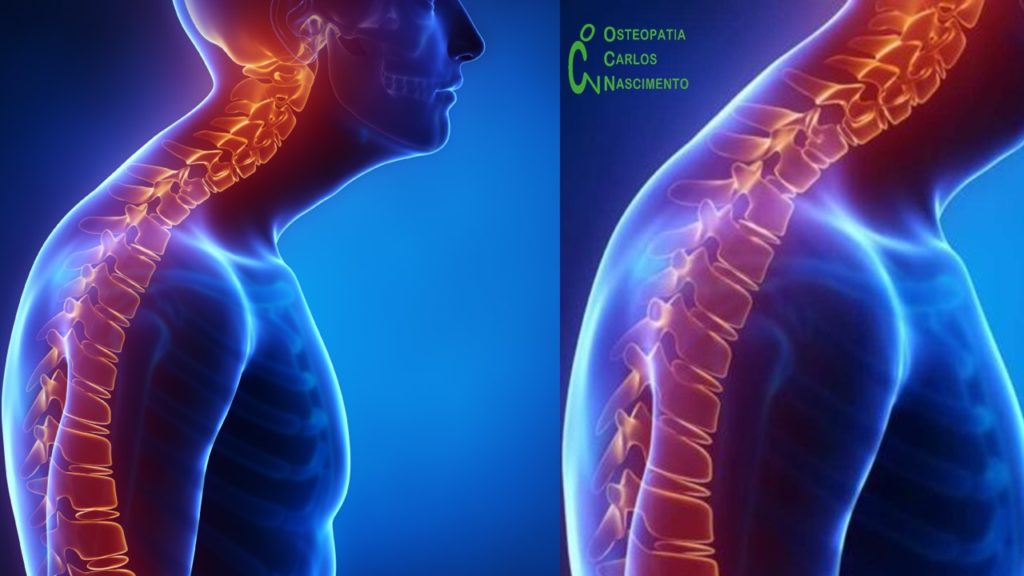 A Osteopatia no tratamento da Hipercifose - Osteopatia Carlos ...